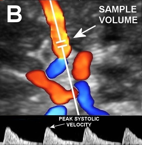 Peak Systolic Blood Flow in the MCA